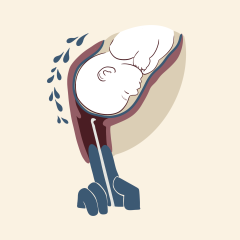 Wat is de onderbouwing van het beleid: vliezen breken? - Vraag de ...